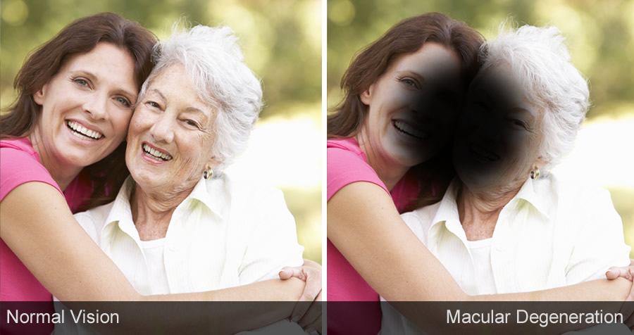 Macular Degeneration Clinic Billings MT Eye Physicians Surgeons 